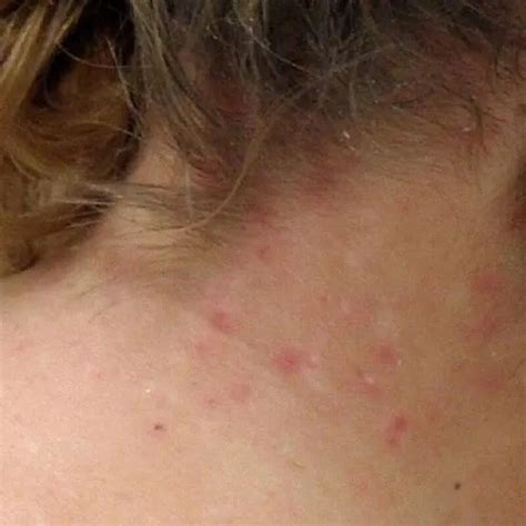 Pediculosis Capitis Head Lice Test Price In Delhi Ganesh Diagnostic