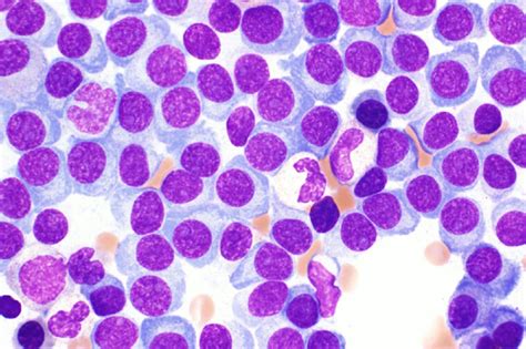A Drug May Improve Stem Cell Transplantation For Multiple Myeloma Patients