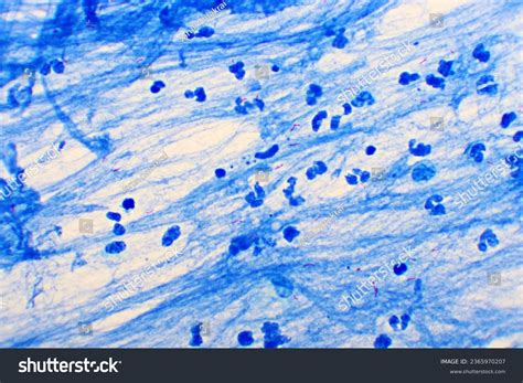 Positive Tb Test Photos Images And Pictures Shutterstock