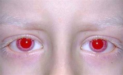 People With Albinism Red Eyes