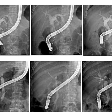 Fluoroscopy With Endoscopic Biliary Stenting Ebs With A Fully Covered