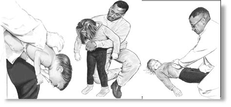 First Aid Of Pediatric Choking Download Scientific Diagram