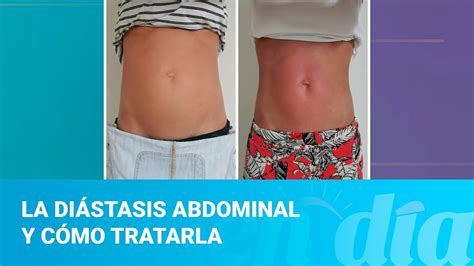 La Diástasis Abdominal Y Cómo Tratarla Youtube