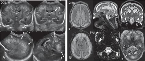 Management Of Hypoxic Ischemic Encephalopathy Using Measures Other Than