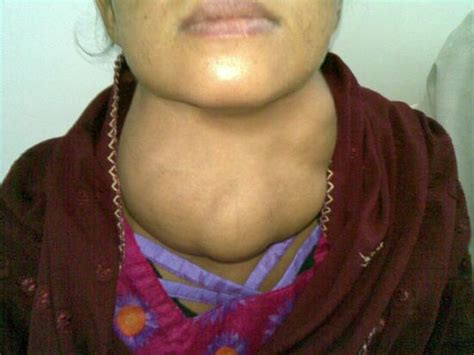 712 The Thyroid Gland Medicine Libretexts