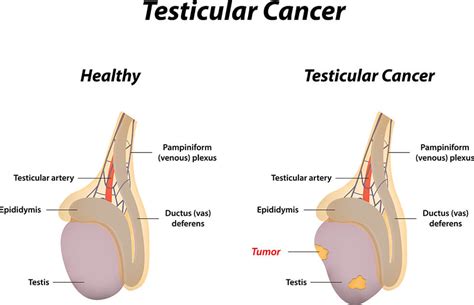 Testicular Cancer Lets Talk About It Denvax