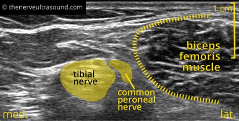 Standard Sections Sciatic Nerve The Nerve Ultrasound
