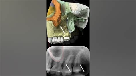 Anatomia Do Arco Zigomatico Arco ZigomÁtico Hirtz Anatomia