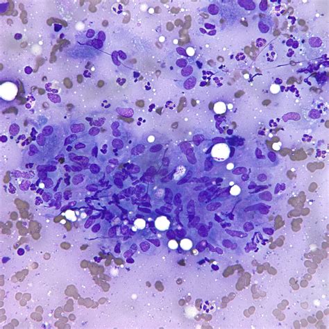 Granulomatous Thyroiditis A Case Report And Literature Review