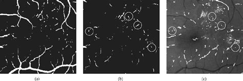 Figure 3 From Automatic Detection Of Red Lesions In Digital Color