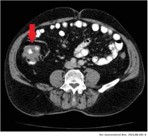 Intestinal Tuberculosis Mimicking Colon Cancer Revista De