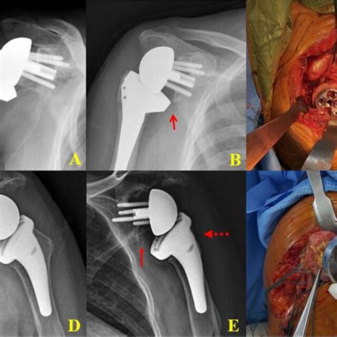Radiologic Complications Of Glenoid Lateralization Reverse Total