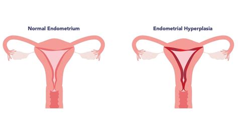 Menopause Endometrial Hyperplasia Endometrial Hyperplasia Causes