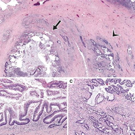Mri Revealing A T2 Signal Hyperintense Multi Lobulated Cystic Lesion