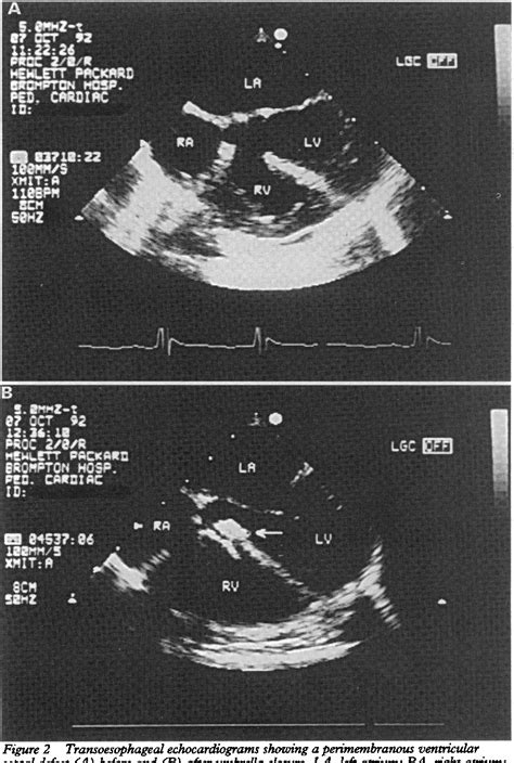 Perimembranous Ventricular Septal Defect Semantic Scholar