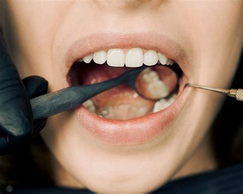 Cavities In Adults