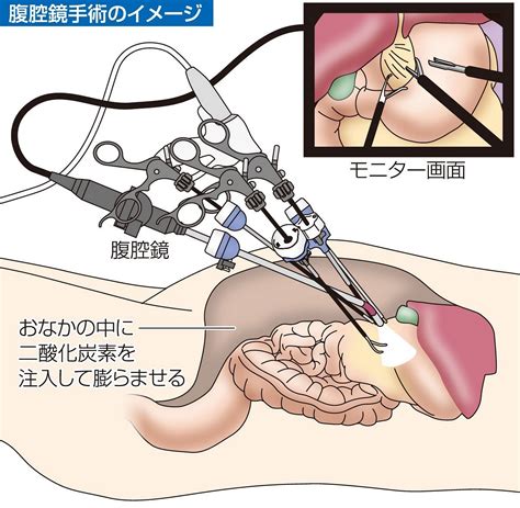 （1）腹腔鏡手術、開腹手術どっちがいいの？ 天和会松田病院副理事長・外科 松田達雄｜岡山の医療健康ガイド Medica