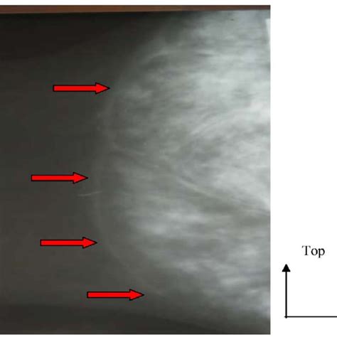 Photograph Showing A Right Gigantomastia Normal Volume Left Breast