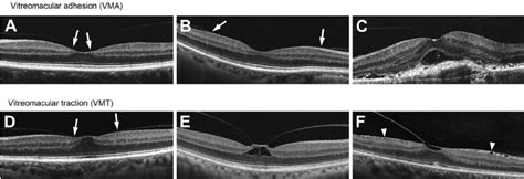 Optical Coherence Tomography Oct Scans Illustrating A E C