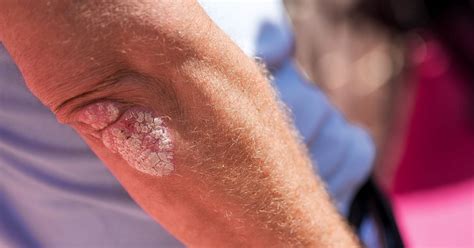 Psoriasis En Plaques Chronique Symptômes Traitement Et Plus