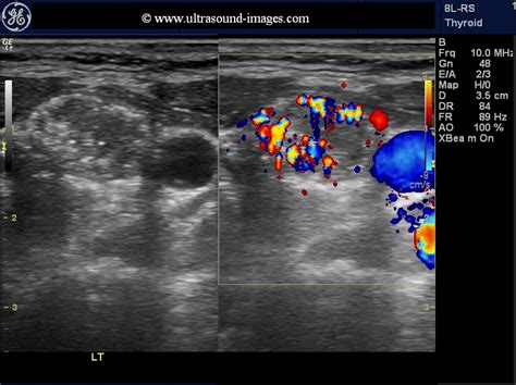 A Gallery Of High Resolution Ultrasound Color Doppler And 3d Images Thyroid 2