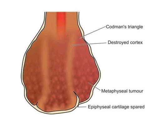 Osteosarcoma Medizzy