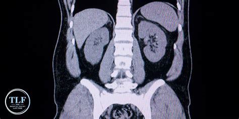 Death From Ct Scan Dye Contrast Dye Medical Malpractice
