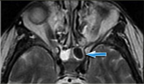 Maxillary And Ethmoid Sinus Disease