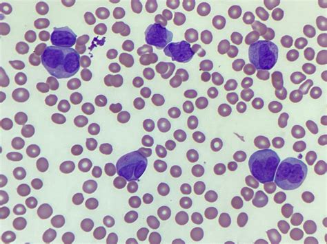 Microgranular Apml Only Cells
