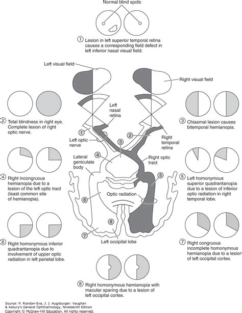 Quadrantanopia Visual Field Defect