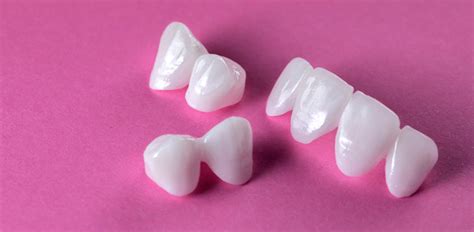 Can Porcelain Veneers Fall Off And What To Do If They Do Edgecliff Dental Care