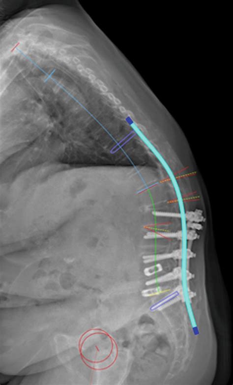 8 Surgical Planning For The Patient Including Ponte Osteotomy At