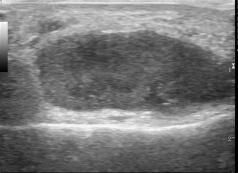 Hematoma Lump Leg Hematoma Overview Types Treatment And Pictures