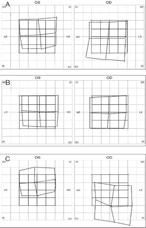 Figure 1 From Hess Lancaster Screen Test With The Head Tilted A Useful