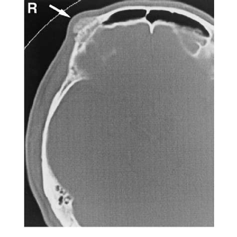 The Bone Window Image Of Computed Tomography Scan Demonstrating The