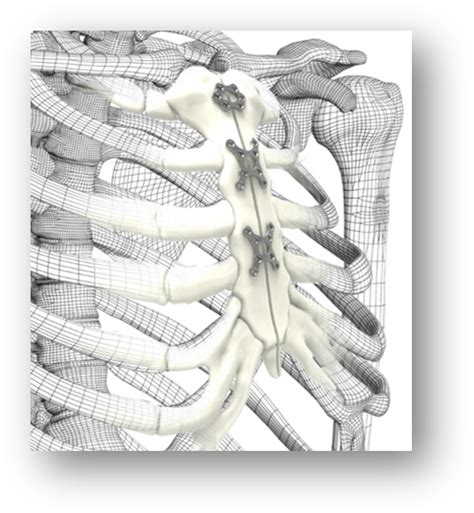 Sternal Wire Cwis Chest Wall Injury Society