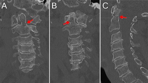 Dens Fracture