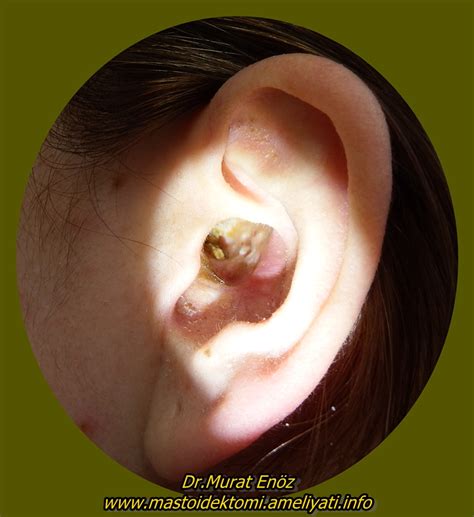 Modified Radical Mastoidectomy Operation