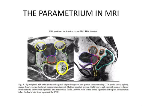 Target Delineation Of Parametrium Pptx