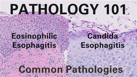 Eosinophilic Esophagitis And Candida Esophagitis Pathology 101 Gi Pathology Youtube