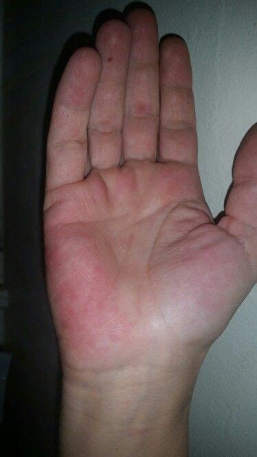 Lupus Rash On Hands