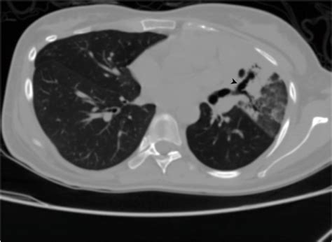 Limited Ct Sections Taken During The Course Of Treatment Showing Areas