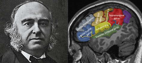 The Broca Area The Neuroradiologist