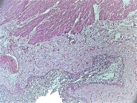 Perforated Jejunal Diverticulitis An Infrequent Cause Of Acute Abdomen