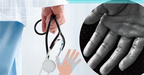 হাত পা ঘামা বা Palmoplanter Hyperhidrosis কি কারণ লক্ষণ এবং চিকিৎসা।