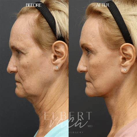 About Elbert Vaca Dr Fagien And Dr Vaca Dr Fagien And Dr Vaca