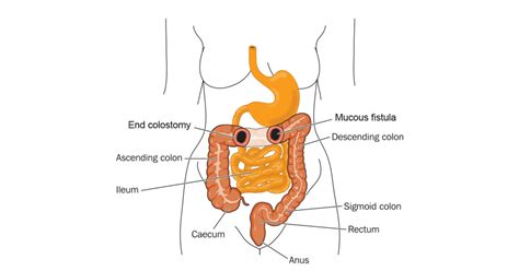 End Colostomy Creation