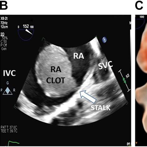 A Right Ventricular Inflow View 3d Rendering Truevue Demonstrating