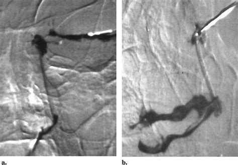 Dacryocystogram After Implantation Of A Stent In Anteroposterior A Download Scientific