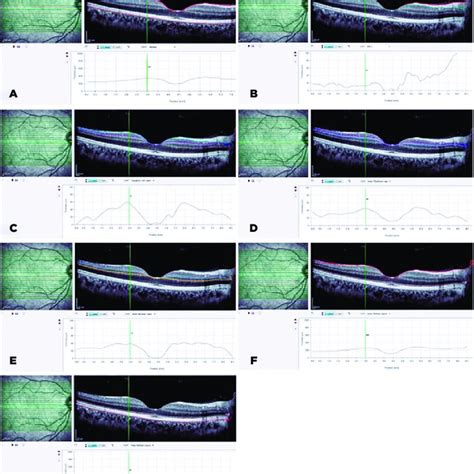The Retinal Layer Thickness That Were Calculated Automatically By